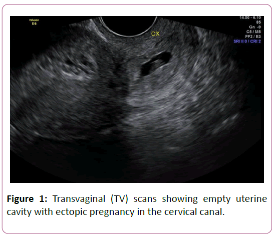 Management Of Live Cervical Ectopic Pregnancy Insight Medical Publishing